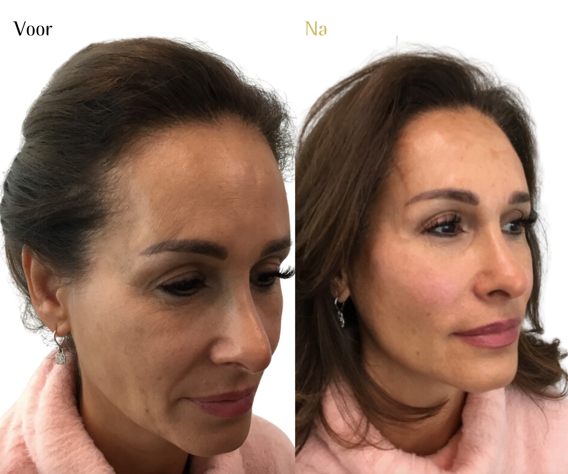Liquid facelift behandeling | Docveer